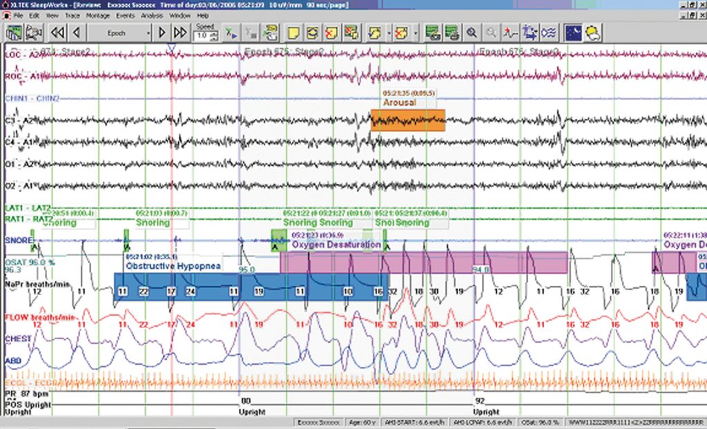 Natus SleepWorks | Stowood